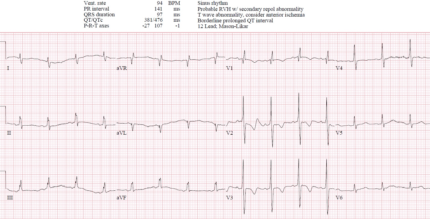 Pulmonary embolism and acute RV strain | ECG Cases 26 | EM Cases