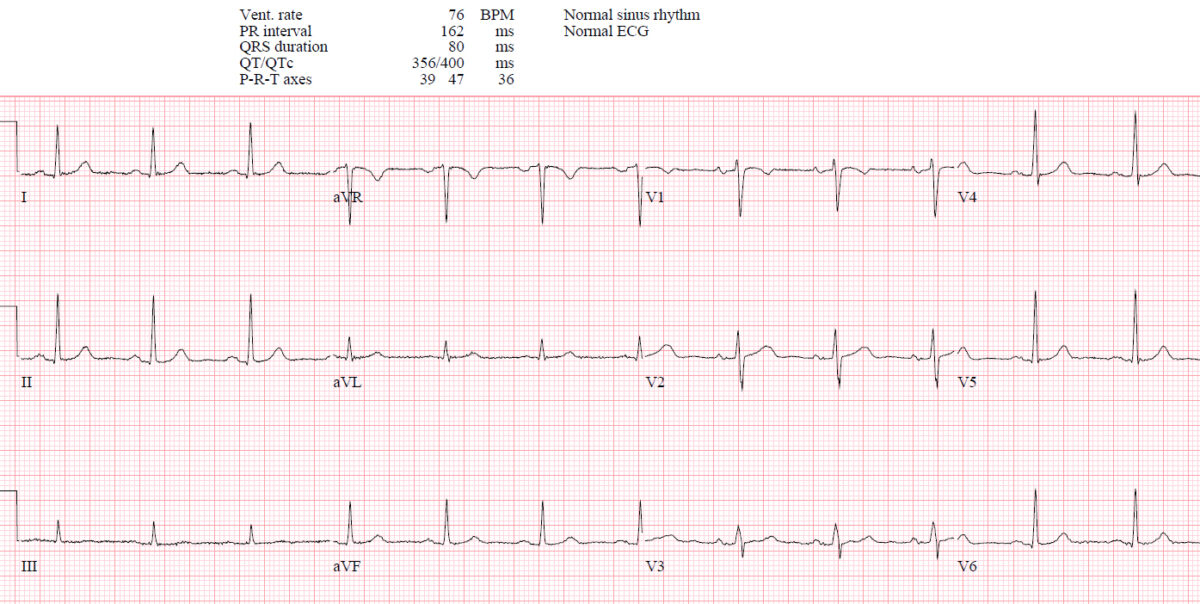 Pulmonary embolism and acute RV strain | ECG Cases 26 | EM Cases