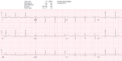 Pulmonary embolism and acute RV strain | ECG Cases 26 | EM Cases