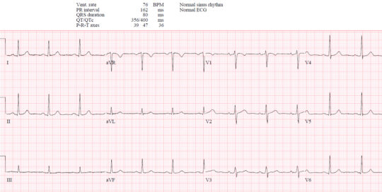 Pulmonary embolism and acute RV strain | ECG Cases 26 | EM Cases
