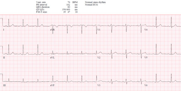 Pulmonary embolism and acute RV strain | ECG Cases 26 | EM Cases