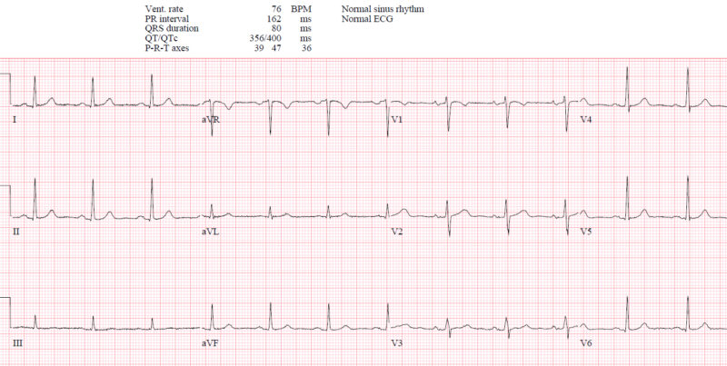 Pulmonary embolism and acute RV strain | ECG Cases 26 | EM Cases