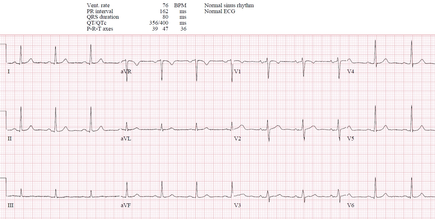 Pulmonary embolism and acute RV strain | ECG Cases 26 | EM Cases