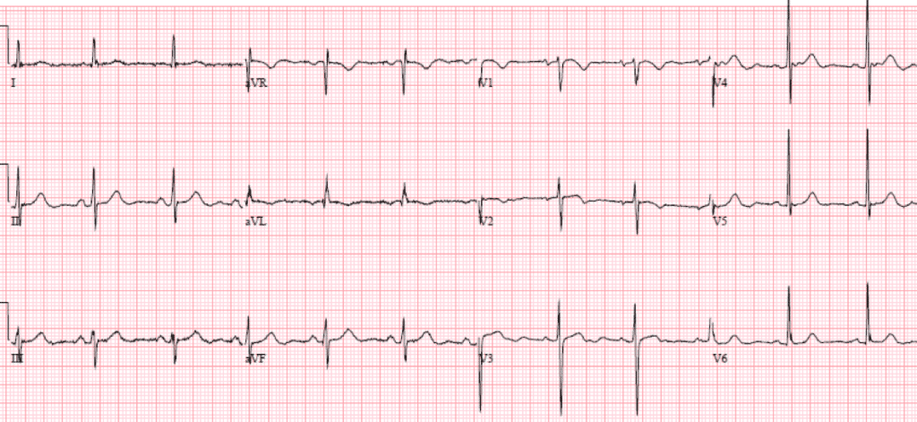 Pulmonary embolism and acute RV strain | ECG Cases 26 | EM Cases