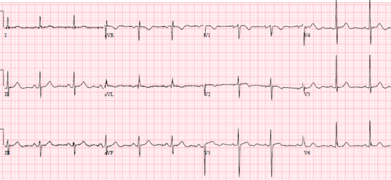Pulmonary embolism and acute RV strain | ECG Cases 26 | EM Cases