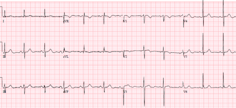 Pulmonary embolism and acute RV strain | ECG Cases 26 | EM Cases