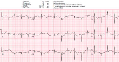 Pulmonary embolism and acute RV strain | ECG Cases 26 | EM Cases