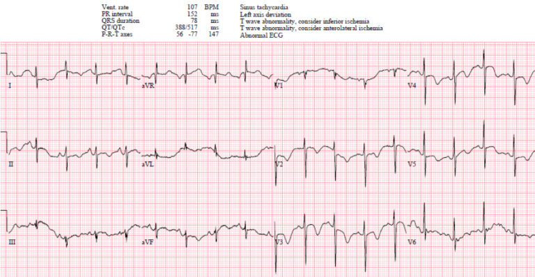 Pulmonary embolism and acute RV strain | ECG Cases 26 | EM Cases