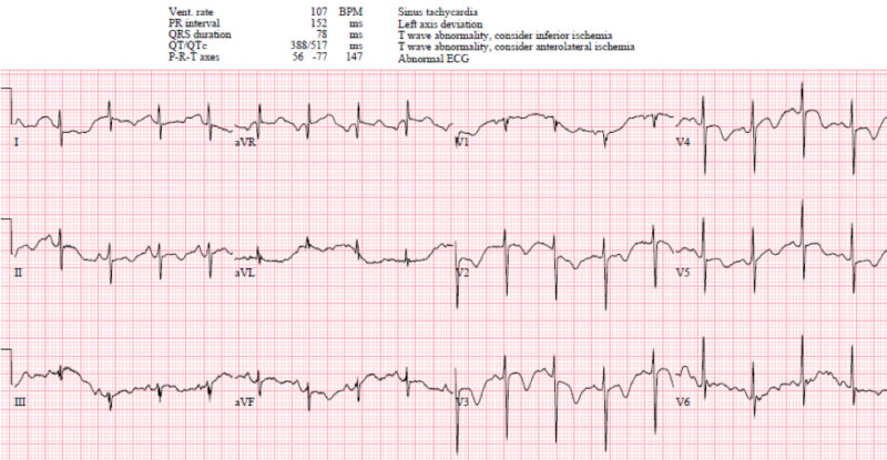 Pulmonary embolism and acute RV strain | ECG Cases 26 | EM Cases