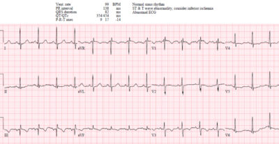 Pulmonary embolism and acute RV strain | ECG Cases 26 | EM Cases
