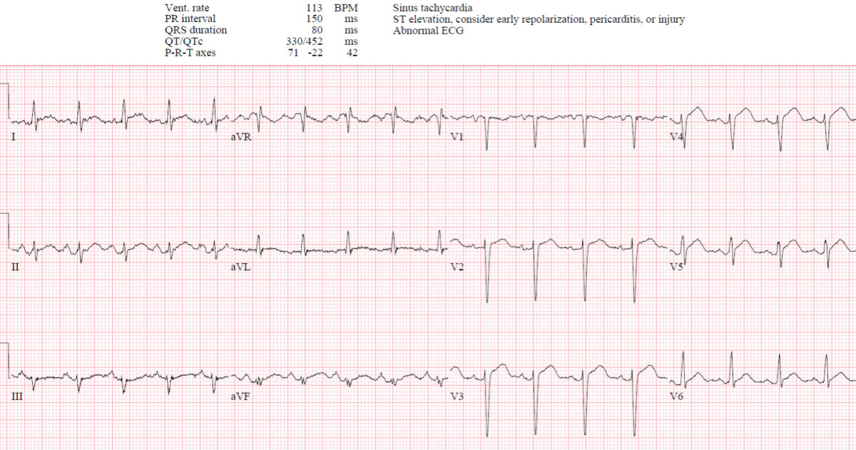 Pericarditis - Diagnosis of Exclusion | ECG Cases | Emergency Medicine ...