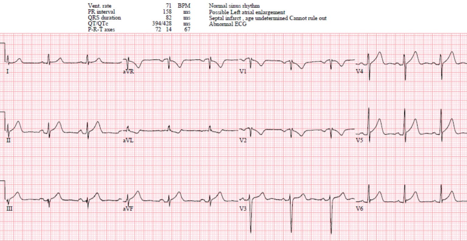 Pericarditis - Diagnosis of Exclusion | ECG Cases | Emergency Medicine ...