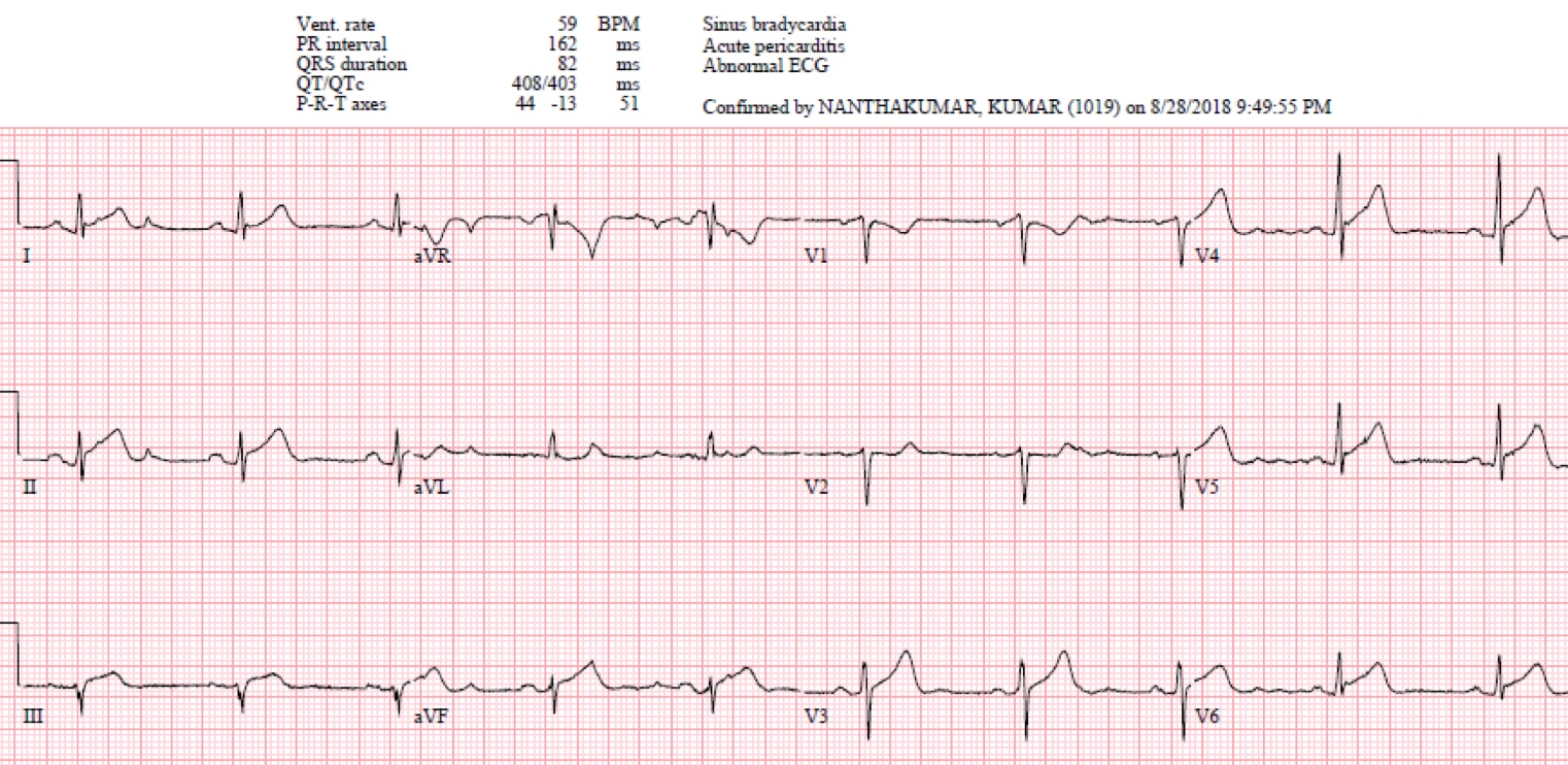 Pericarditis - Diagnosis of Exclusion | ECG Cases | Emergency Medicine ...