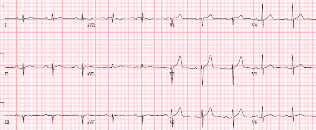 Pericarditis - Diagnosis of Exclusion | ECG Cases | Emergency Medicine ...
