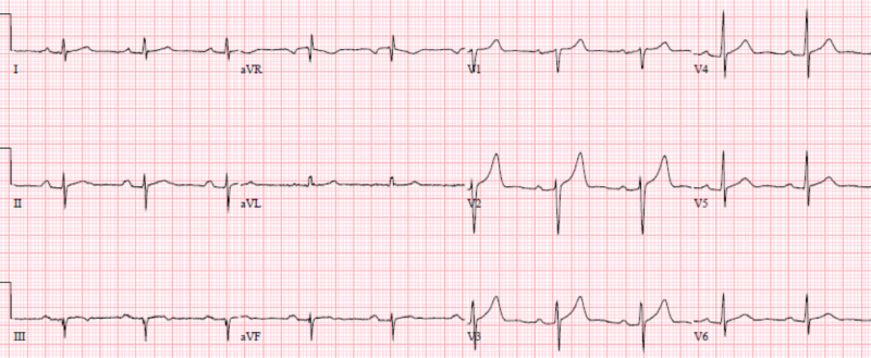 Pericarditis - Diagnosis of Exclusion | ECG Cases | Emergency Medicine ...
