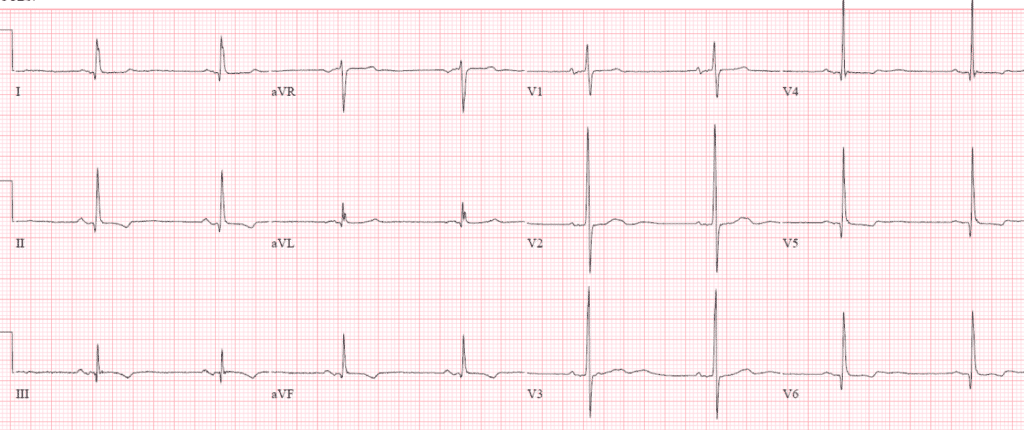 Pericarditis - Diagnosis of Exclusion | ECG Cases | Emergency Medicine ...