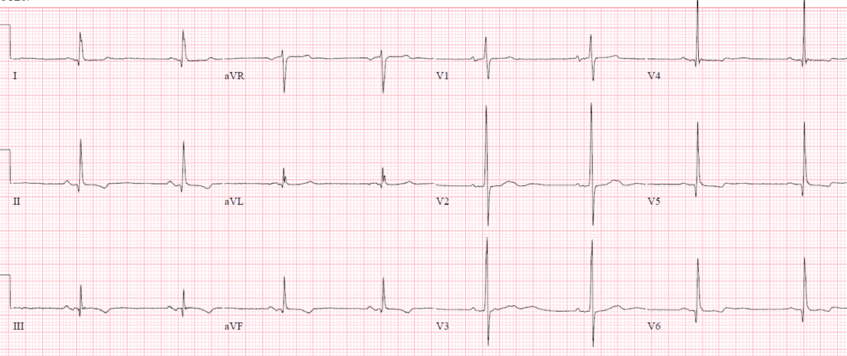 Pericarditis - Diagnosis of Exclusion | ECG Cases | Emergency Medicine ...