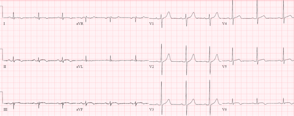 Pericarditis - Diagnosis of Exclusion | ECG Cases | Emergency Medicine ...