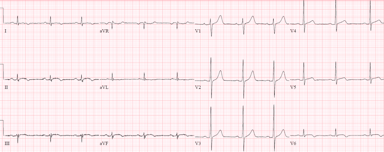 Pericarditis - Diagnosis of Exclusion | ECG Cases | Emergency Medicine ...