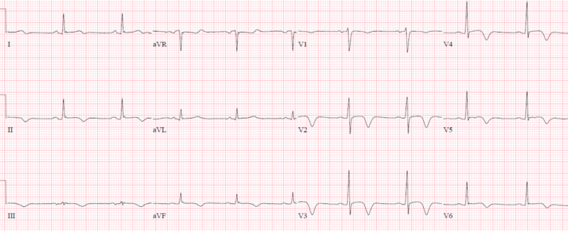 Pericarditis - Diagnosis of Exclusion | ECG Cases | Emergency Medicine ...