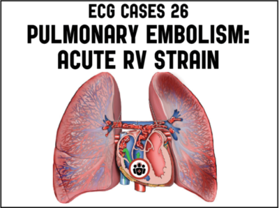 Pulmonary embolism and acute RV strain | ECG Cases 26 | EM Cases
