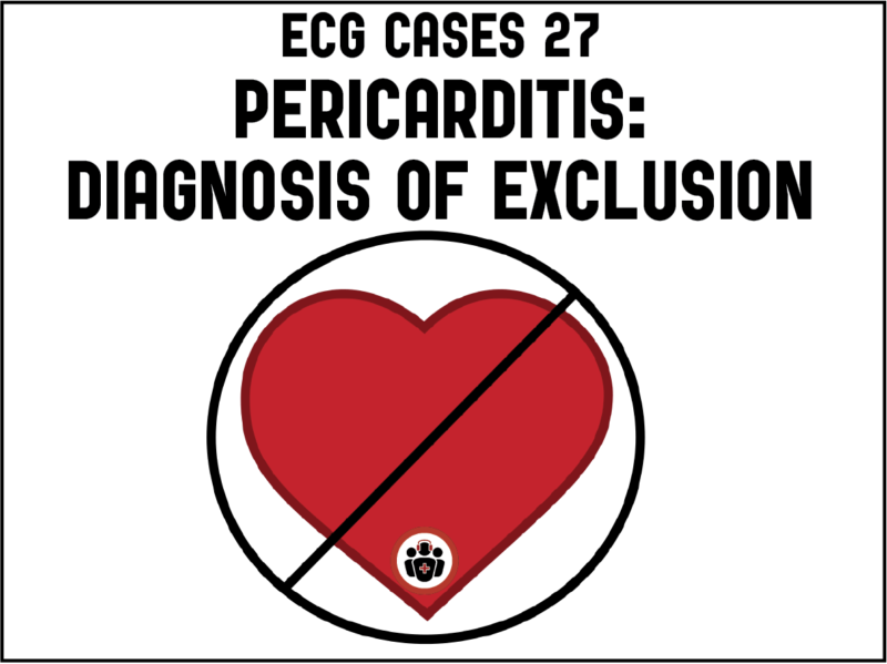 Pericarditis - Diagnosis of Exclusion | ECG Cases | Emergency Medicine ...