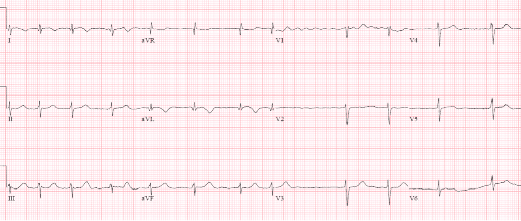 ECG Approach to Atrial Fibrillation | ECG Cases | Emergency Medicine Cases