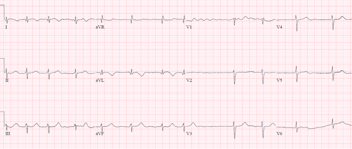 ECG Approach to Atrial Fibrillation | ECG Cases | Emergency Medicine Cases