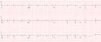 ECG Approach to Atrial Fibrillation | ECG Cases | Emergency Medicine Cases