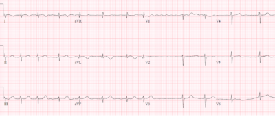ECG Approach to Atrial Fibrillation | ECG Cases | Emergency Medicine Cases