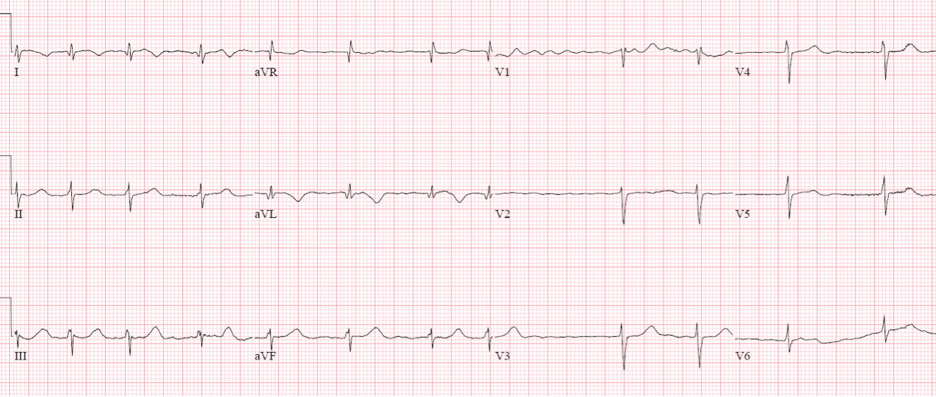 ECG Approach to Atrial Fibrillation | ECG Cases | Emergency Medicine Cases
