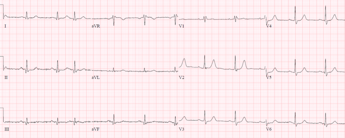 ECG Approach to Atrial Fibrillation | ECG Cases | Emergency Medicine Cases
