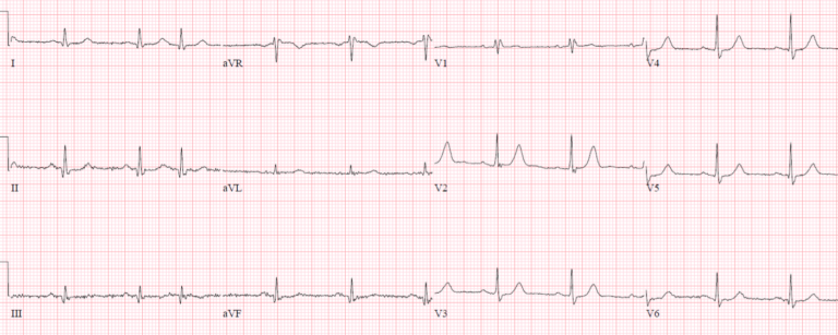 ECG Approach to Atrial Fibrillation | ECG Cases | Emergency Medicine Cases