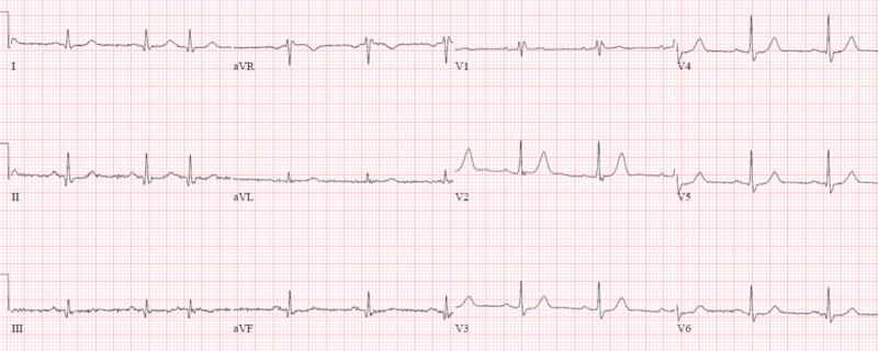 ECG Approach to Atrial Fibrillation | ECG Cases | Emergency Medicine Cases