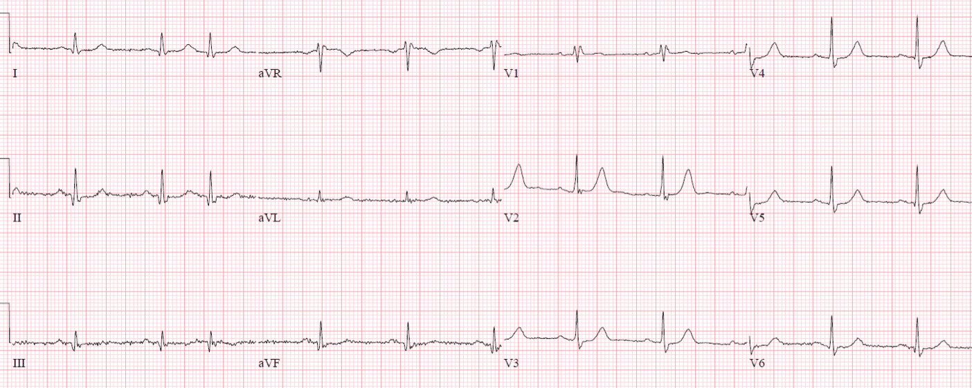 ECG Approach to Atrial Fibrillation | ECG Cases | Emergency Medicine Cases