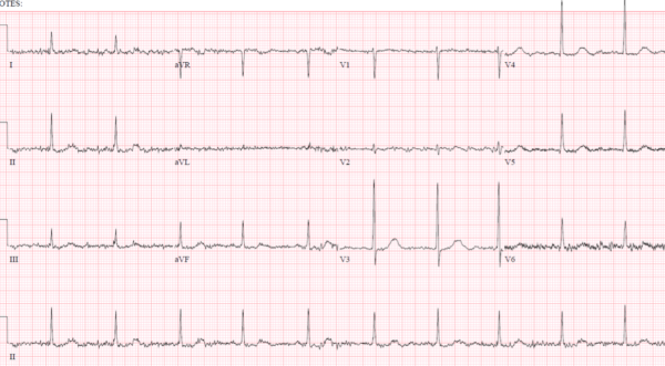 ECG Approach to Atrial Fibrillation | ECG Cases | Emergency Medicine Cases