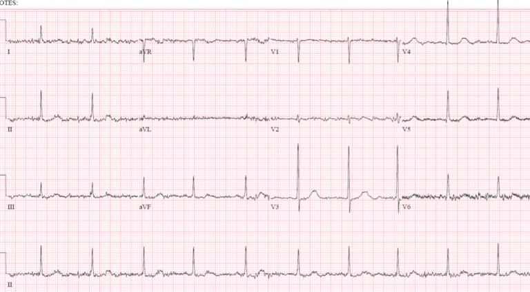 ECG Approach to Atrial Fibrillation | ECG Cases | Emergency Medicine Cases