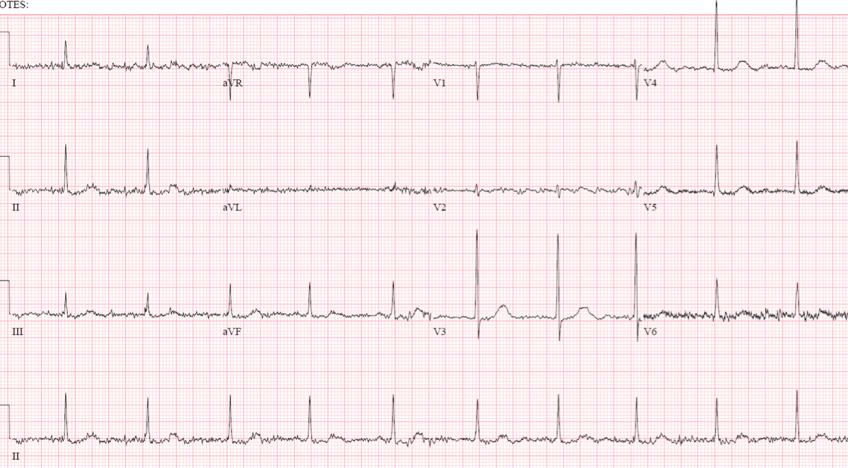 ECG Approach to Atrial Fibrillation | ECG Cases | Emergency Medicine Cases