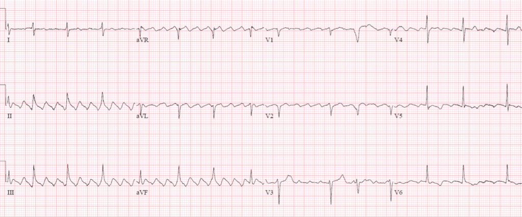 ECG Approach to Atrial Fibrillation | ECG Cases | Emergency Medicine Cases