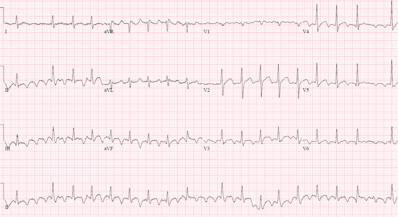 ECG Approach to Atrial Fibrillation | ECG Cases | Emergency Medicine Cases