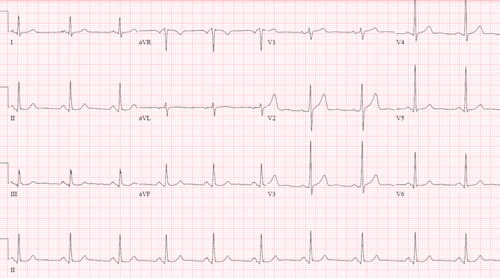 ECG Approach to Atrial Fibrillation | ECG Cases | Emergency Medicine Cases