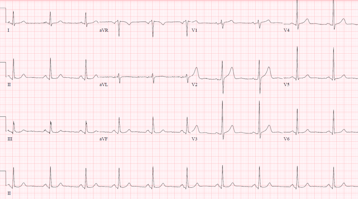 ECG Approach to Atrial Fibrillation | ECG Cases | Emergency Medicine Cases