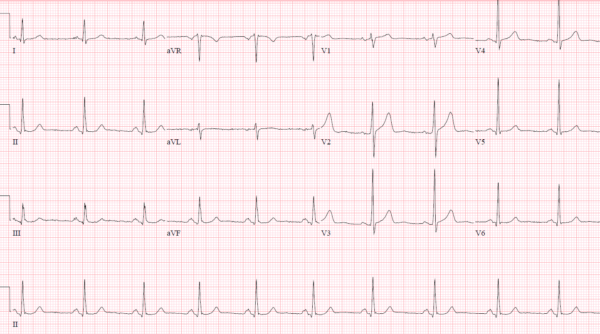 ECG Approach to Atrial Fibrillation | ECG Cases | Emergency Medicine Cases