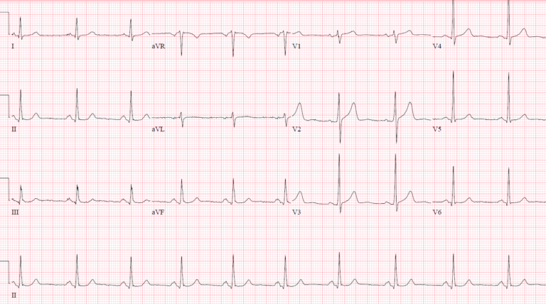 ECG Approach to Atrial Fibrillation | ECG Cases | Emergency Medicine Cases