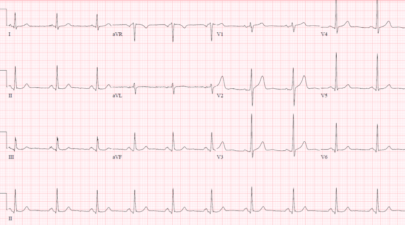 ECG Approach to Atrial Fibrillation | ECG Cases | Emergency Medicine Cases