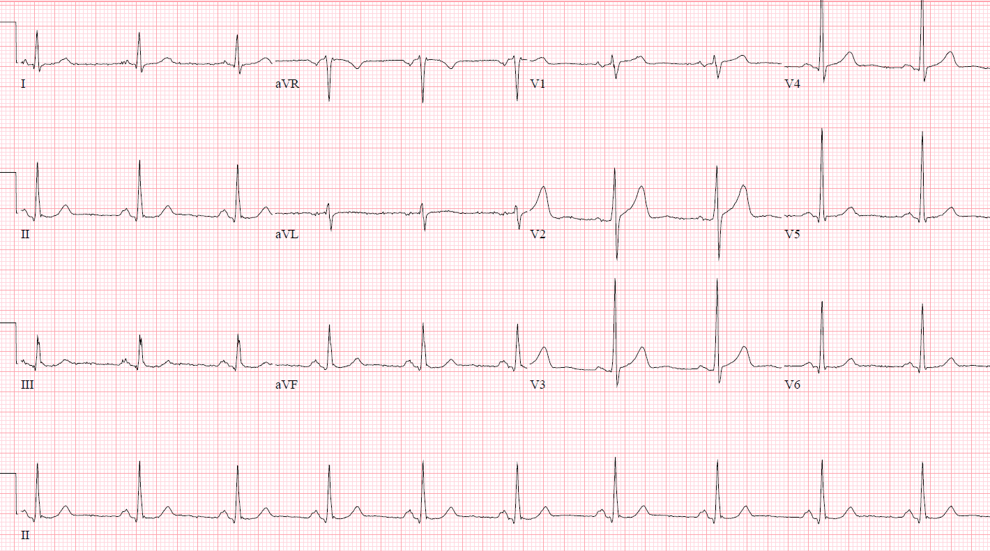 ECG Approach to Atrial Fibrillation | ECG Cases | Emergency Medicine Cases