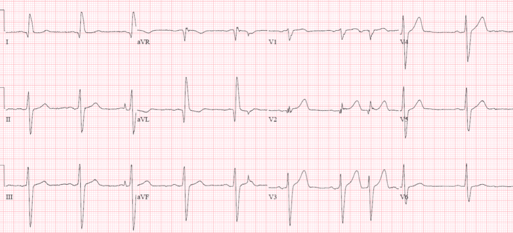 ECG Approach to Atrial Fibrillation | ECG Cases | Emergency Medicine Cases