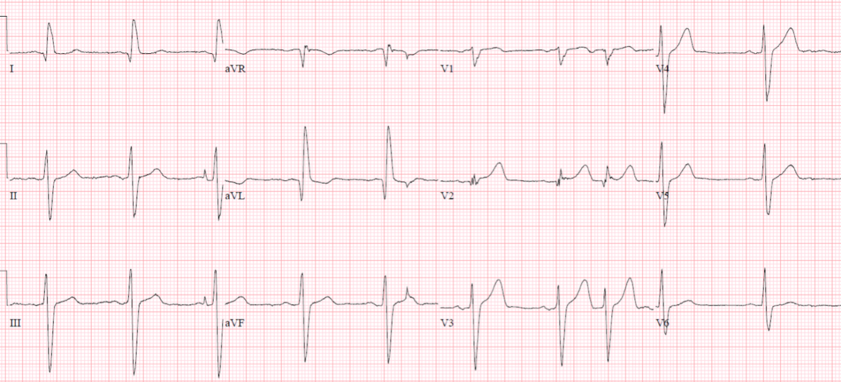 ECG Approach to Atrial Fibrillation | ECG Cases | Emergency Medicine Cases