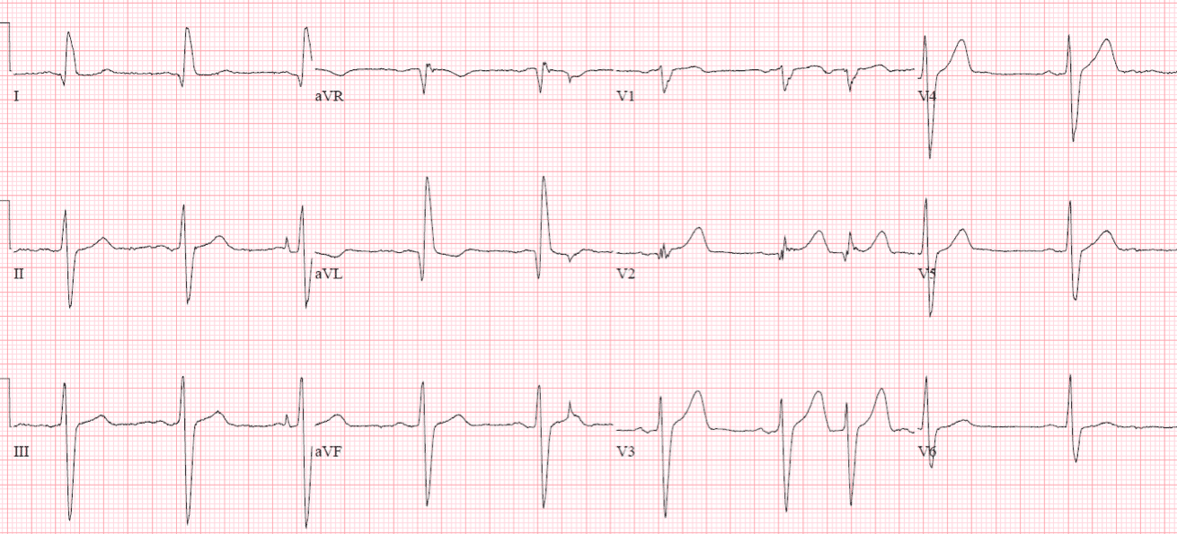 ECG Approach to Atrial Fibrillation | ECG Cases | Emergency Medicine Cases