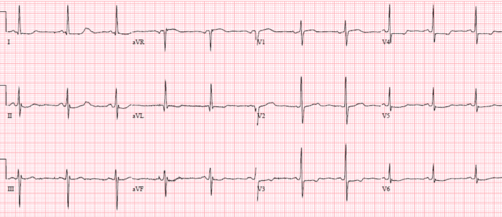 ECG Approach to Atrial Fibrillation | ECG Cases | Emergency Medicine Cases